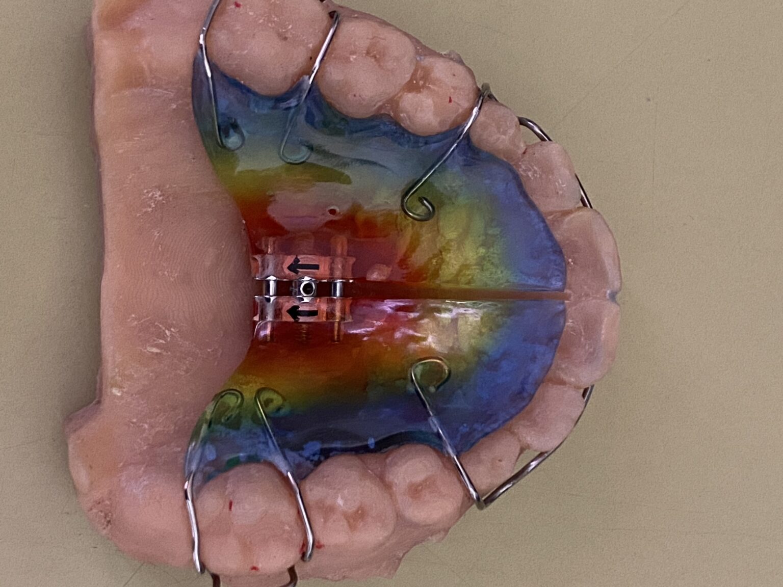 Placca di Swartz - Los Ortodonzia