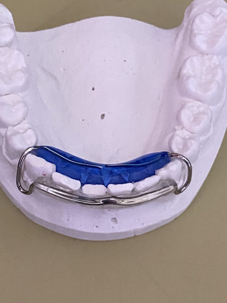 Spring retainer anteriore - Los Ortodonzia